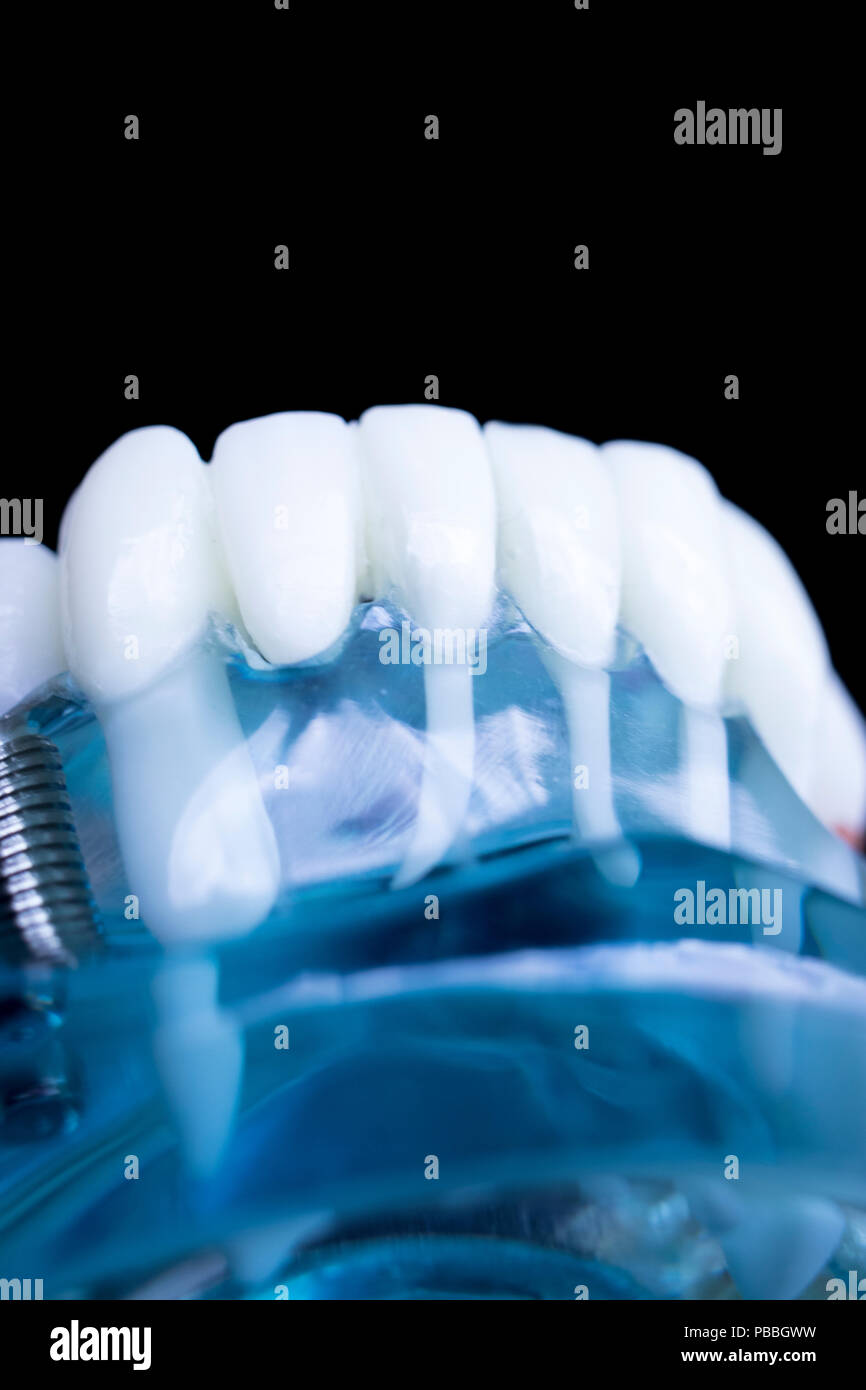 Dentist dental teeth teaching model showing titanium metal tooth ...