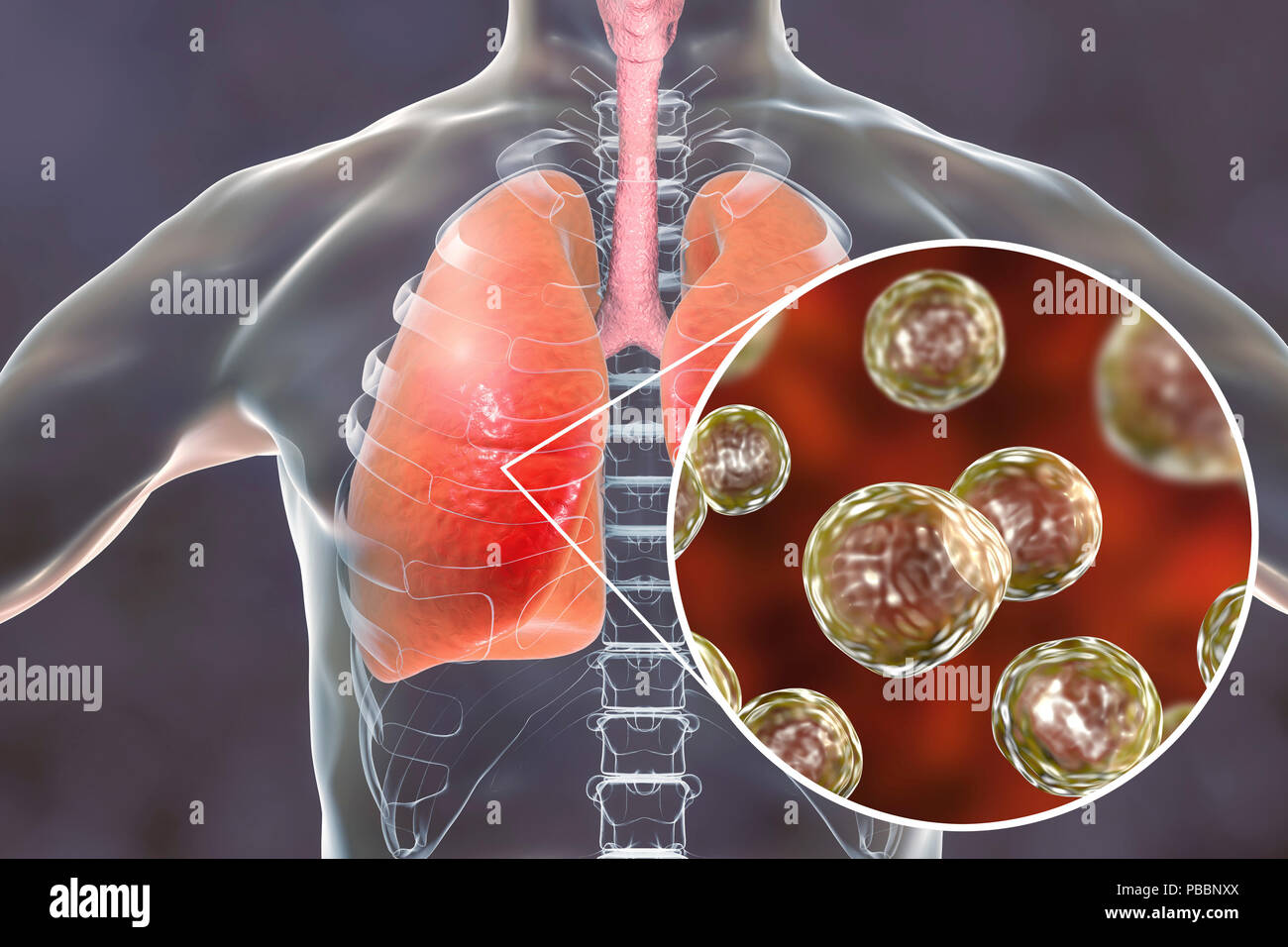 Pulmonary blastomycosis, conceptual illustration. Blastomyces ...