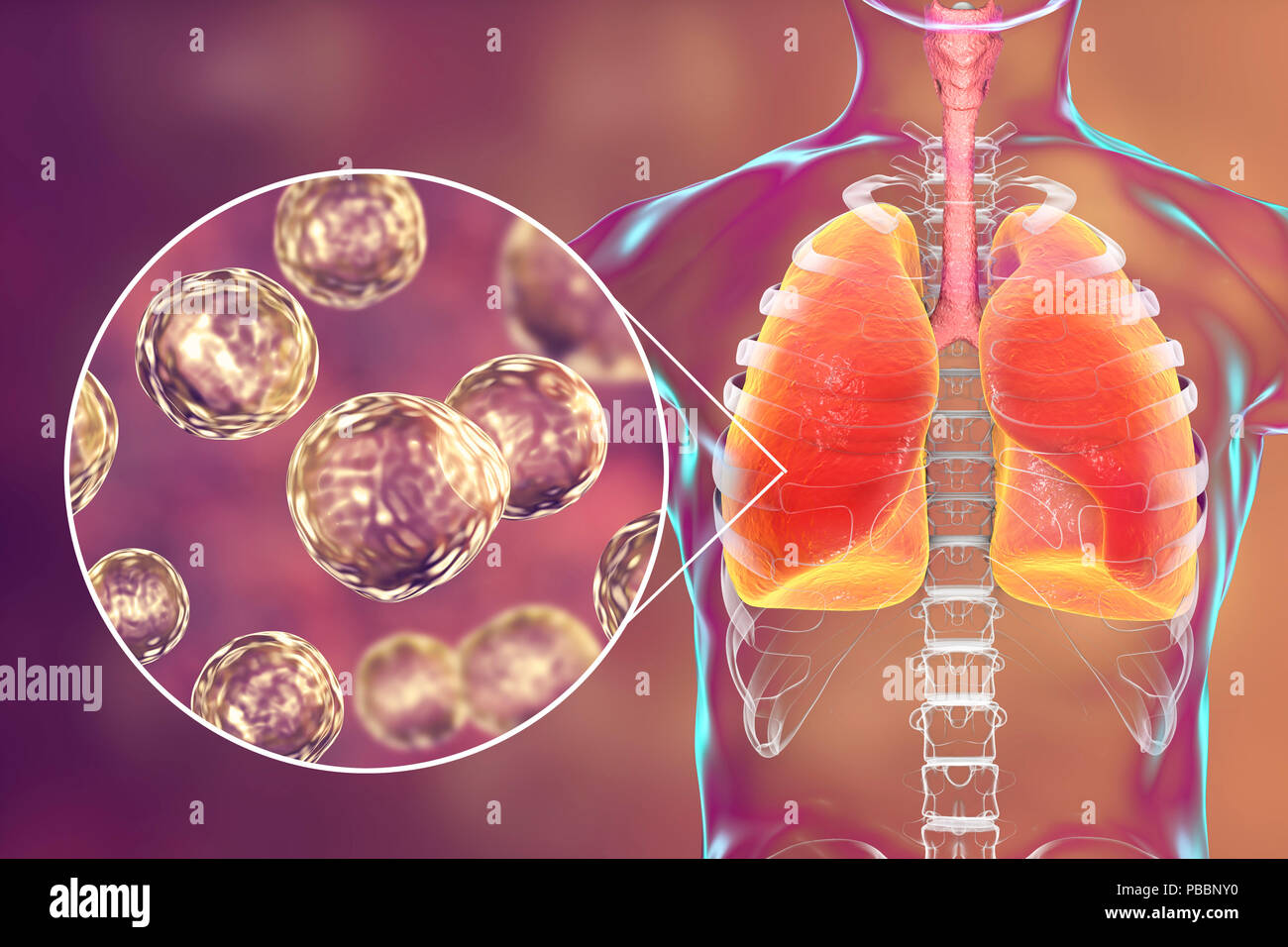 Blastomycosis hi-res stock photography and images - Alamy
