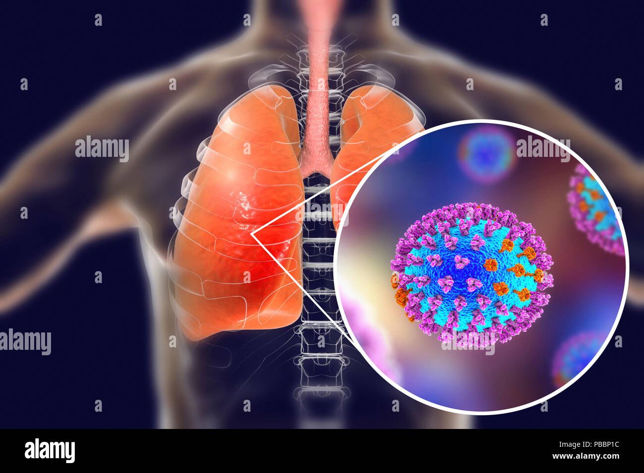 Pneumonia caused by flu hi-res stock photography and images - Alamy