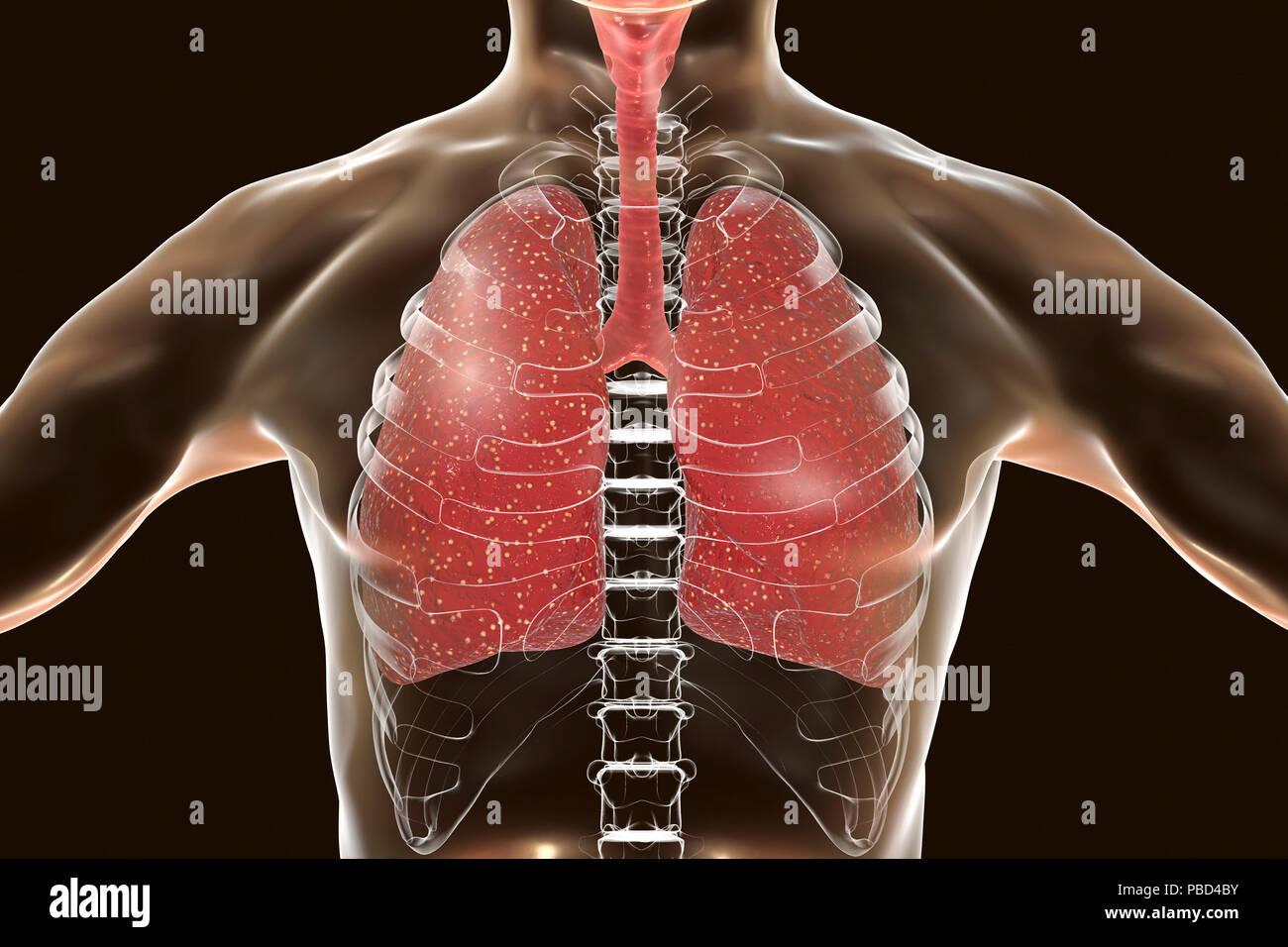 Miliary tuberculosis, computer illustration. Miliary tuberculosis is a ...