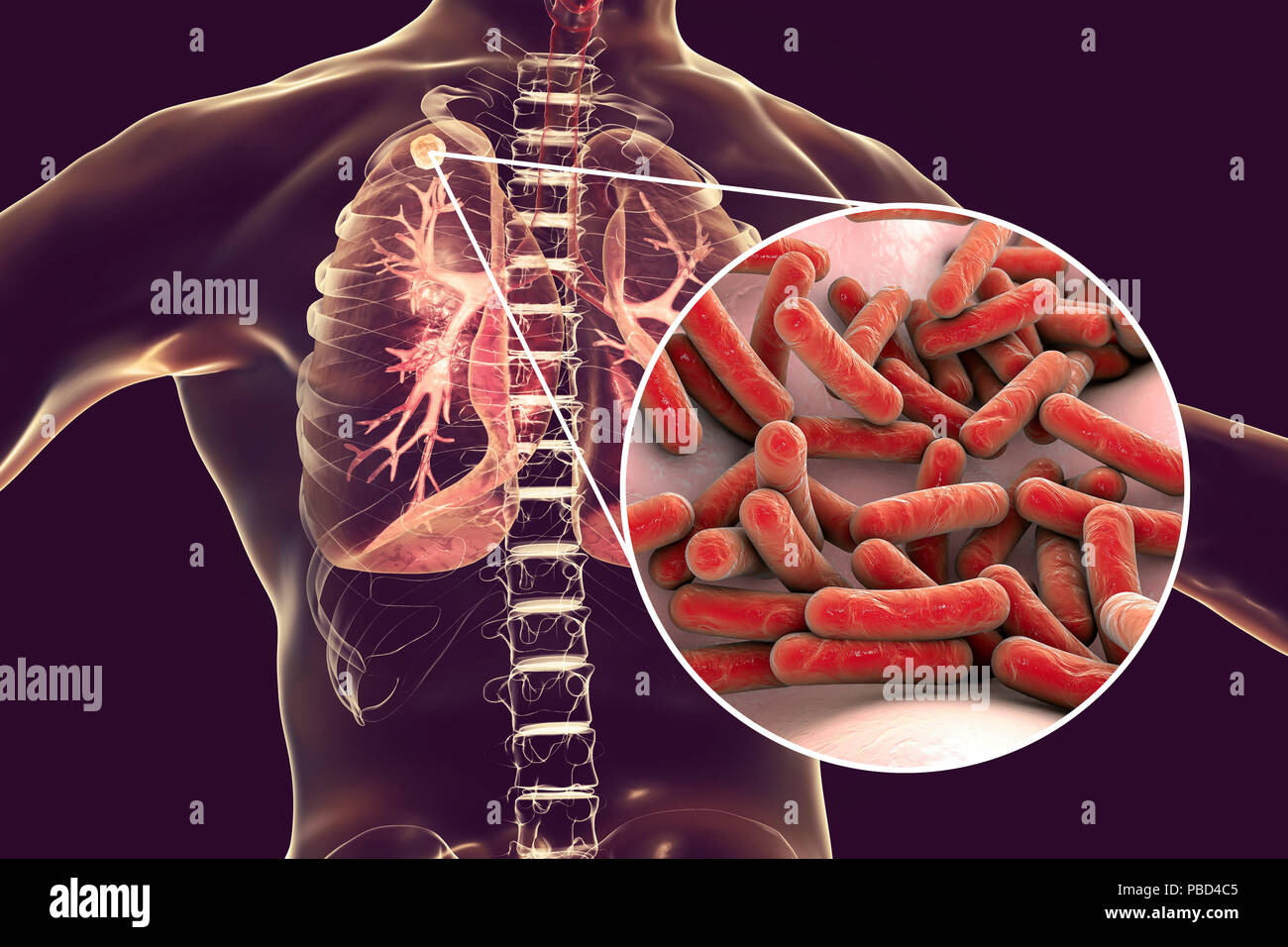 Secondary tuberculosis infection and close-up view of Mycobacterium ...