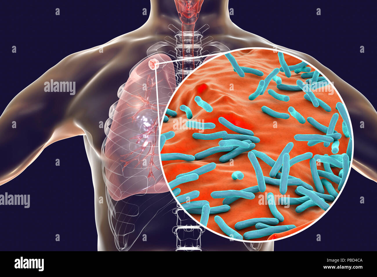 Secondary tuberculosis infection and close-up view of Mycobacterium ...