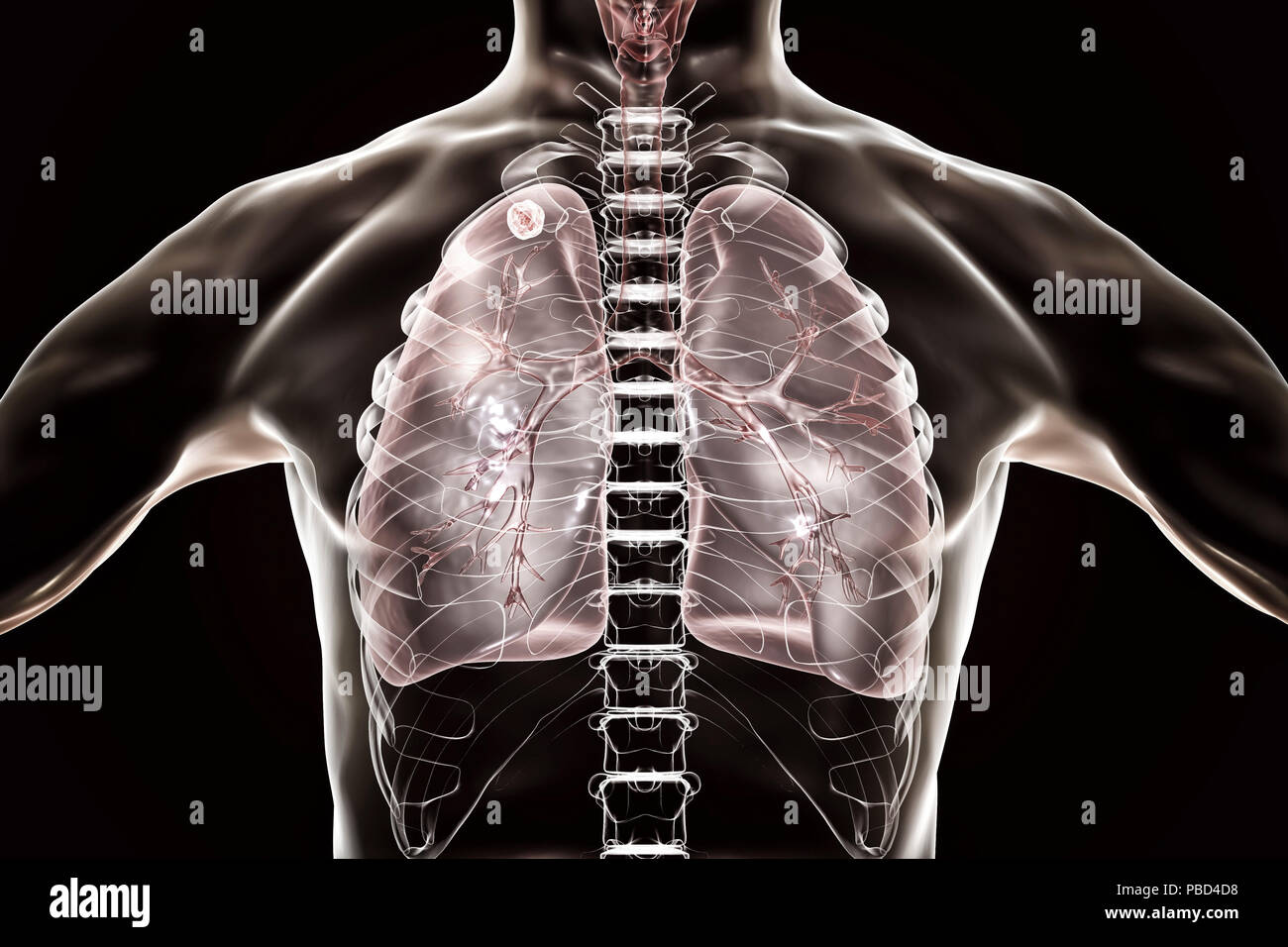 Secondary tuberculosis infection. Computer illustration showing small ...