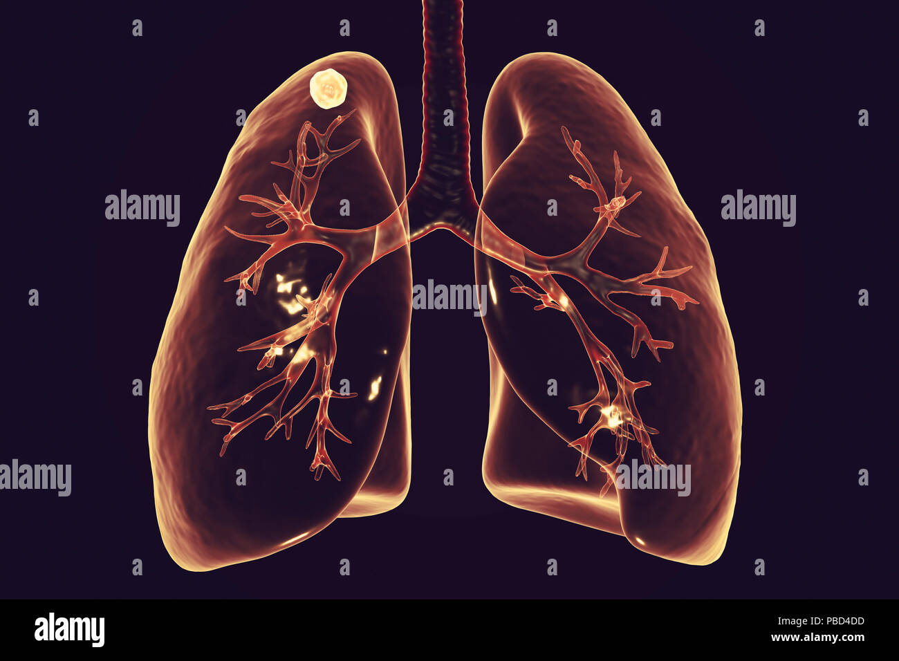 Tuberculosis Lung Stock Photos & Tuberculosis Lung Stock Images - Alamy