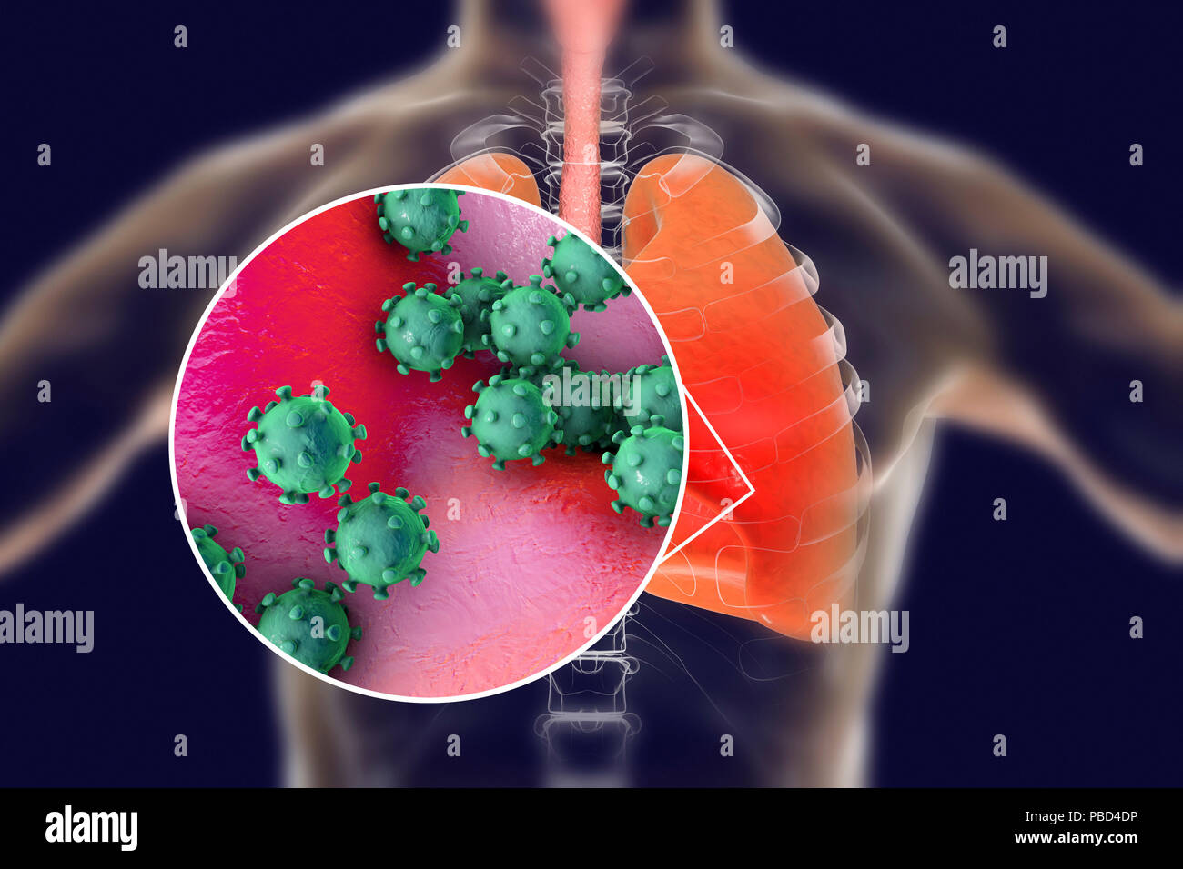 Viral pneumonia, conceptual illustration. Human lungs and close-up view ...