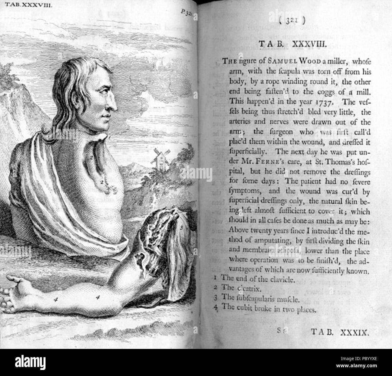 Arm surgery Black and White Stock Photos & Images - Alamy