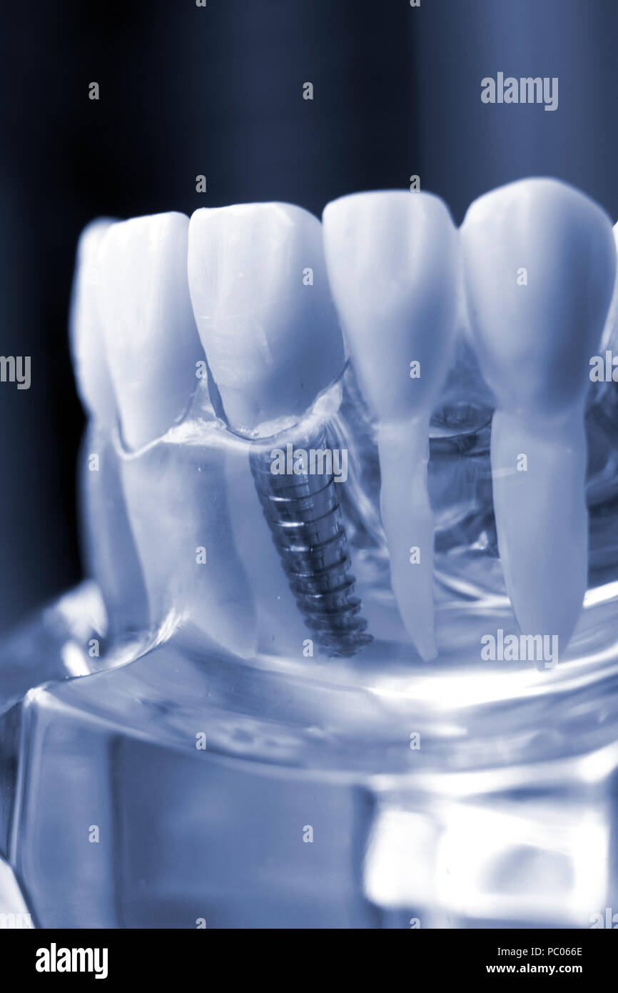 Dentist dental teeth teaching model showing titanium metal tooth ...