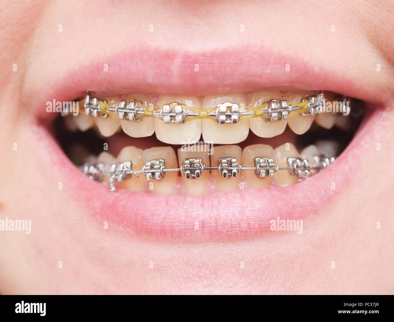 Brackets people human human hi-res stock photography and images - Alamy