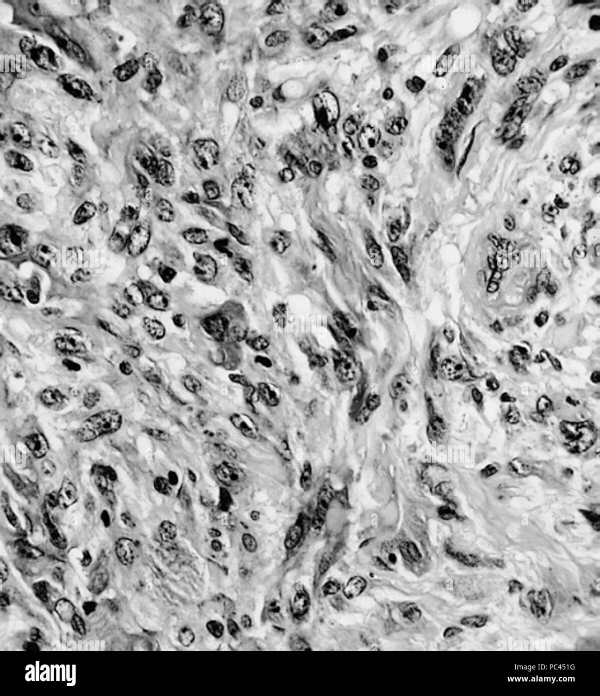 Gliosarcoma hi-res stock photography and images - Alamy