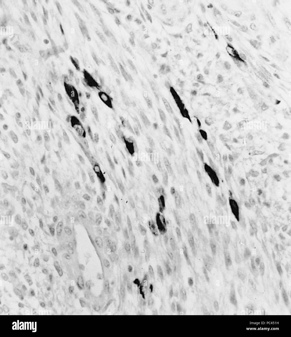 Gliosarcoma hi-res stock photography and images - Alamy