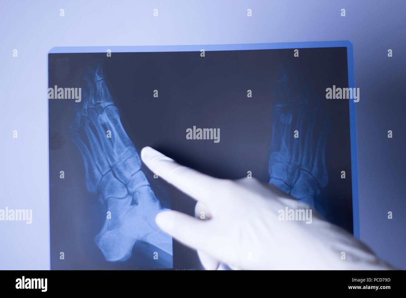 Medical hospital x-ray feet traumatology scan Stock Photo - Alamy