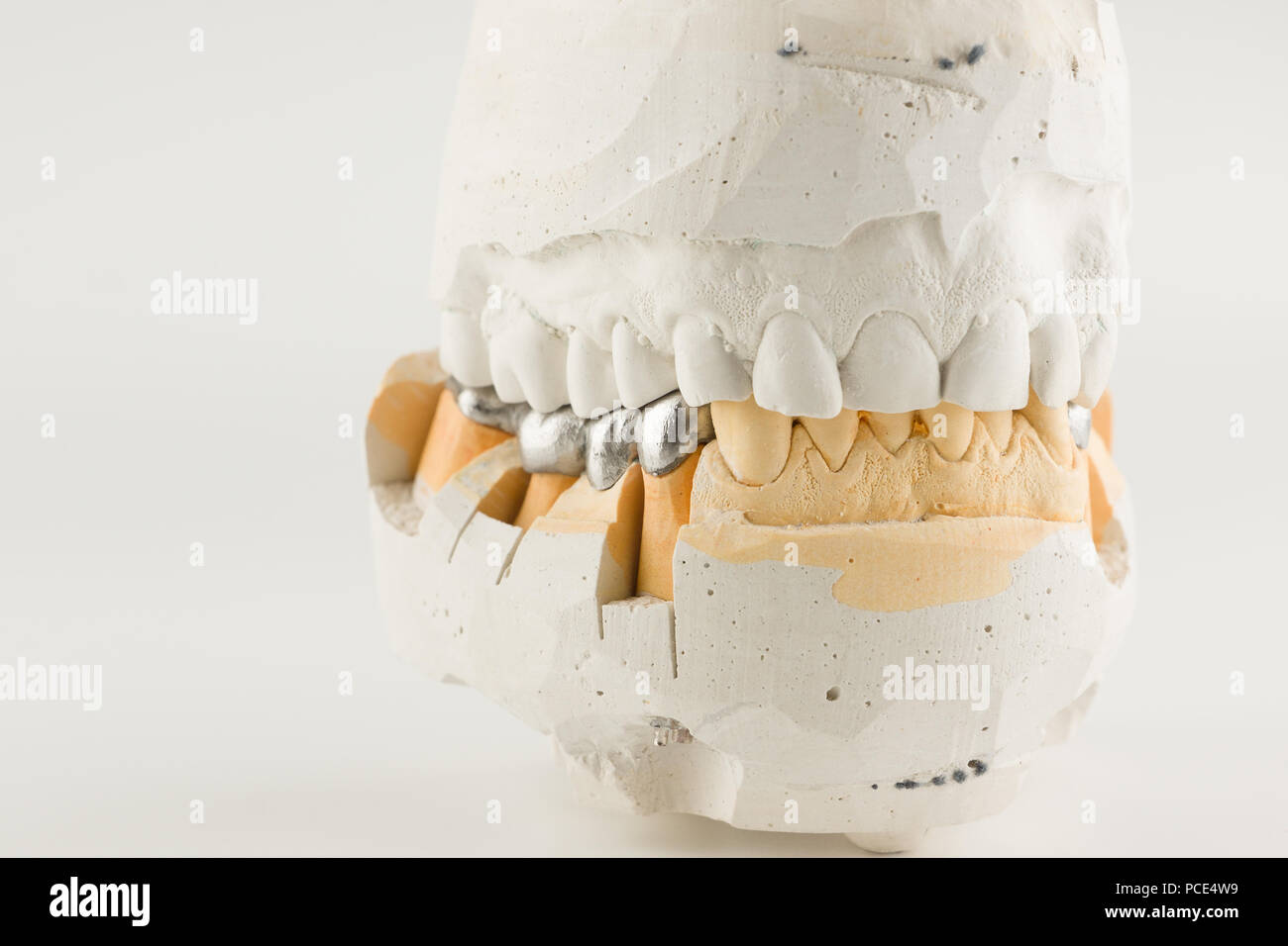 bases of metal-cast bridges on an artificial dental model Stock Photo ...