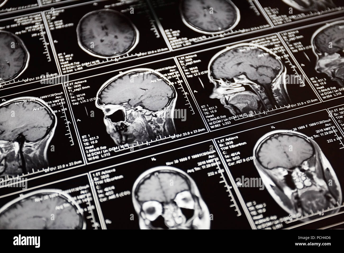 Magnetic resonance scan of the brain. MRI head scan Stock Photo - Alamy