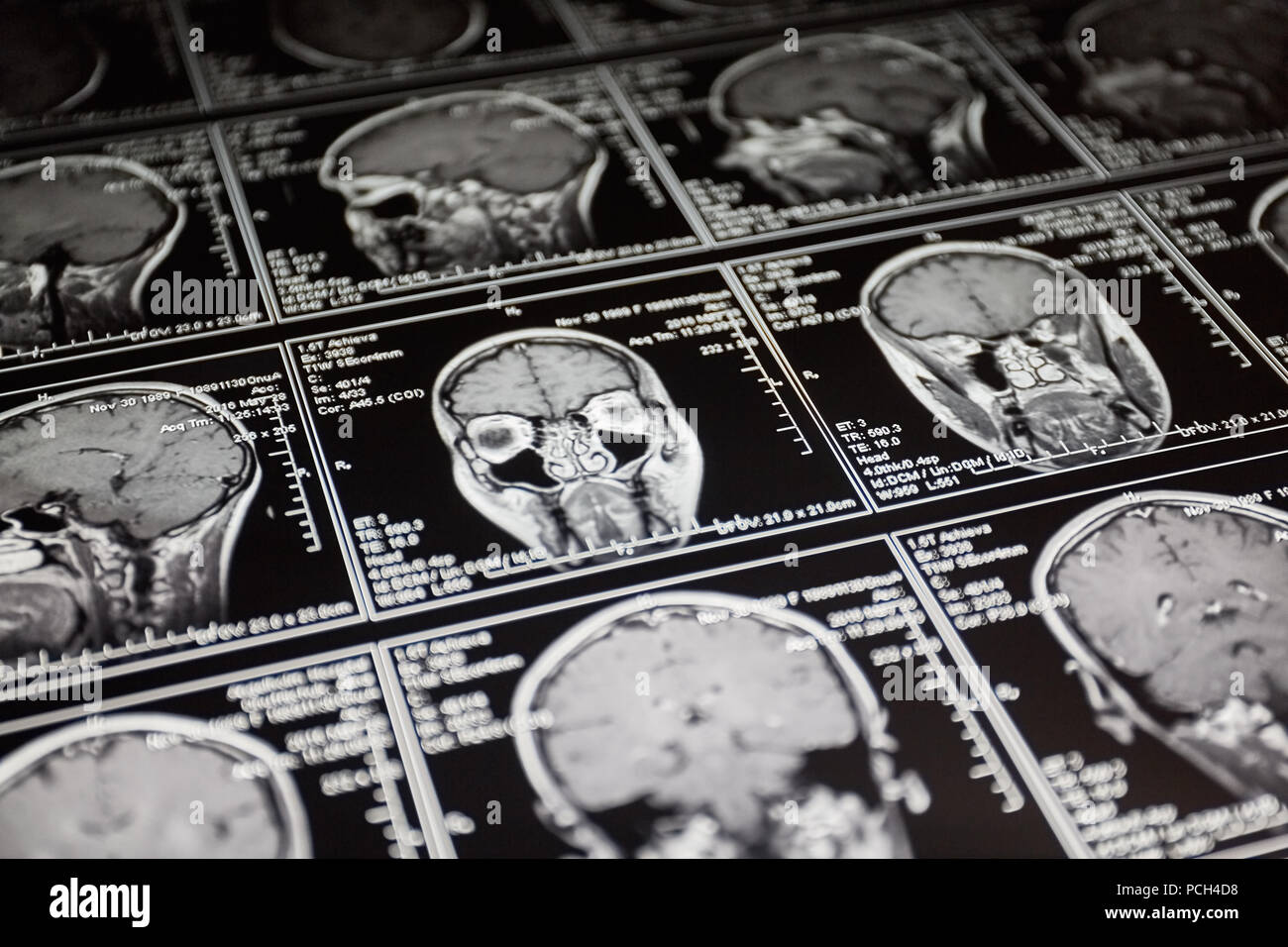 Magnetic resonance scan of the brain. MRI head scan Stock Photo - Alamy