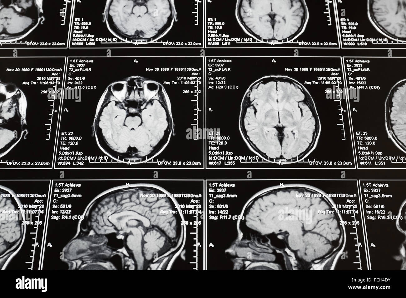 Magnetic resonance scan of the brain. MRI head scan Stock Photo - Alamy