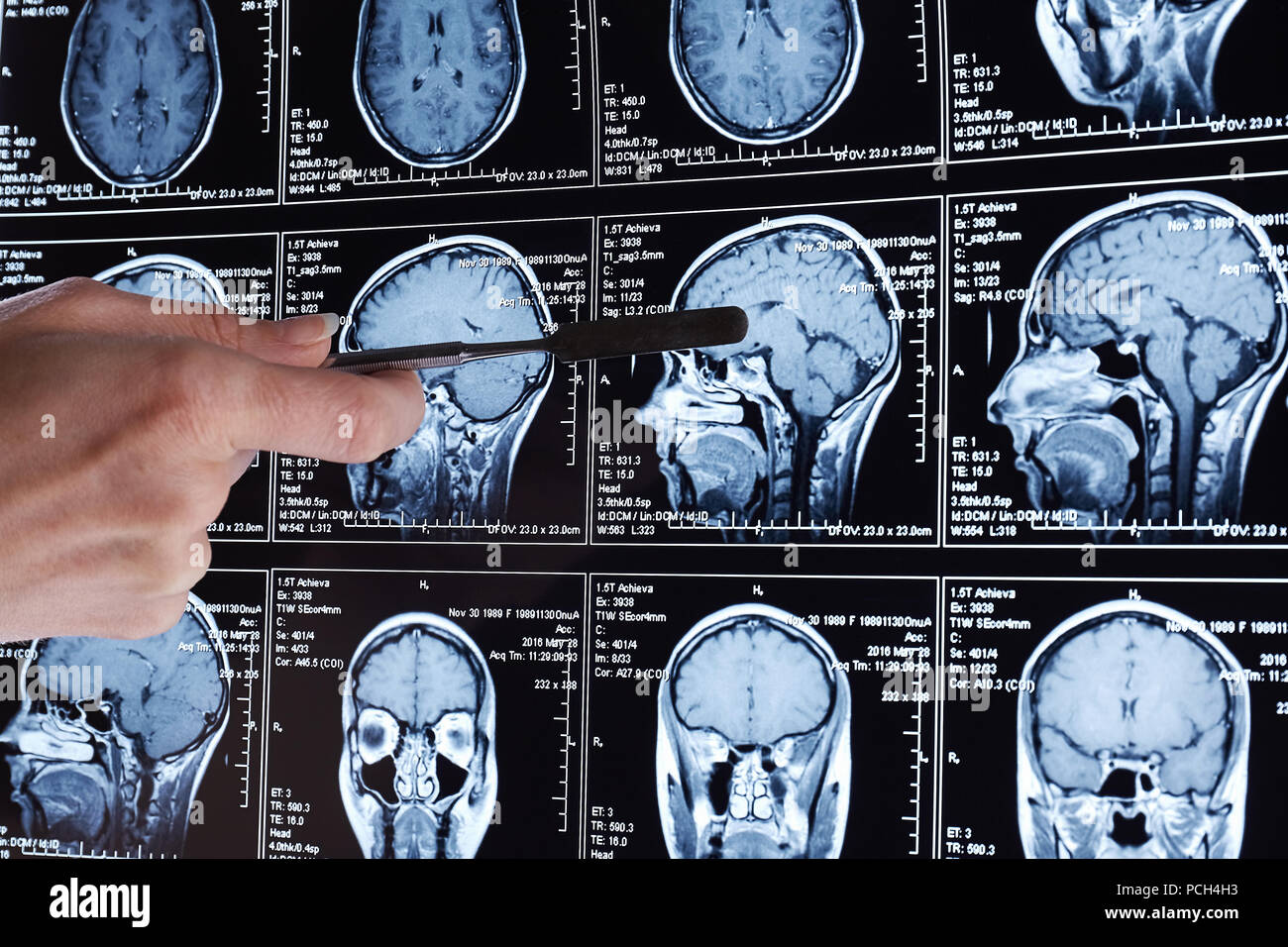 Magnetic resonance scan of the brain. MRI head scan Stock Photo - Alamy