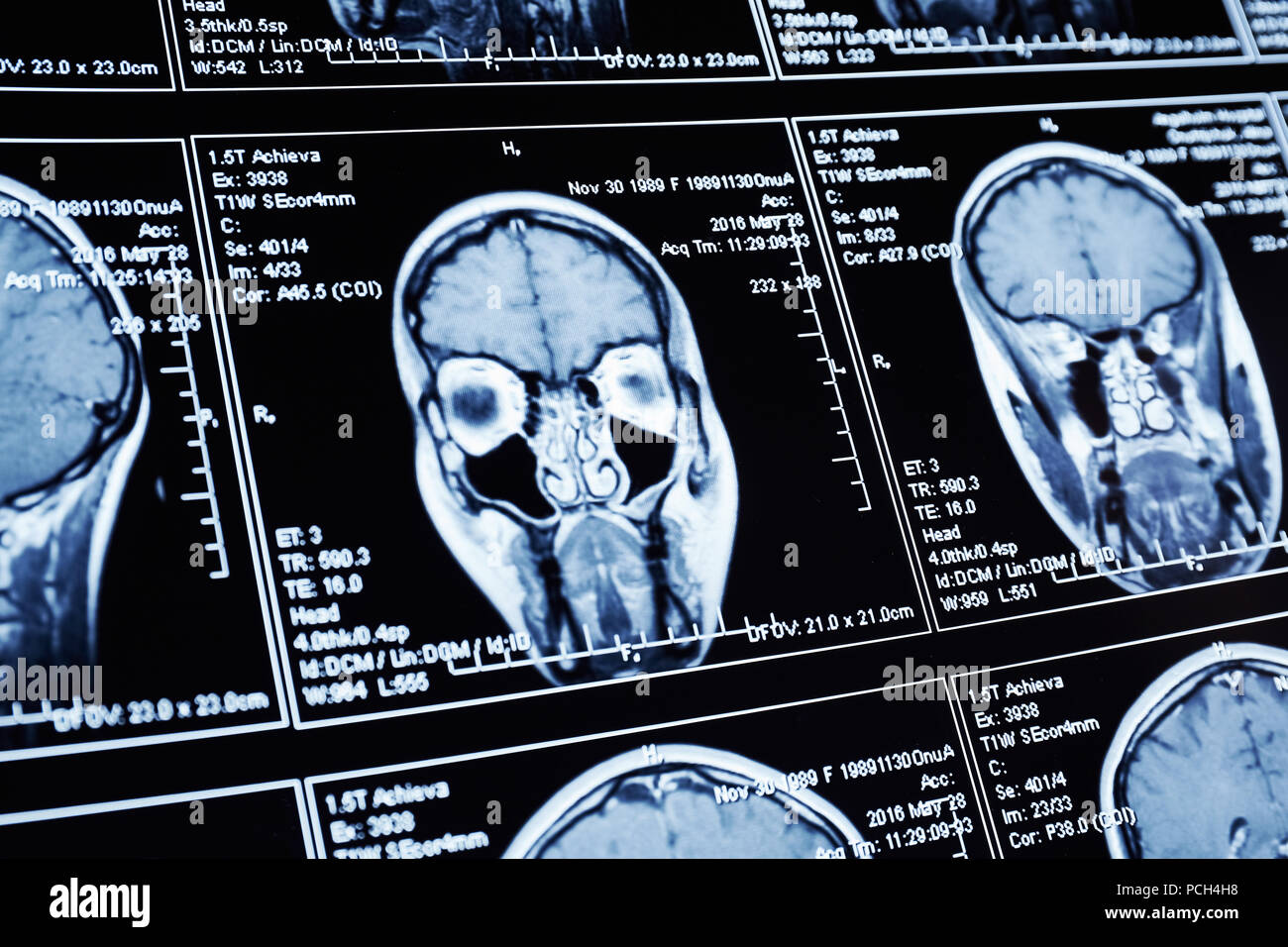 Magnetic resonance scan of the brain. MRI head scan Stock Photo - Alamy
