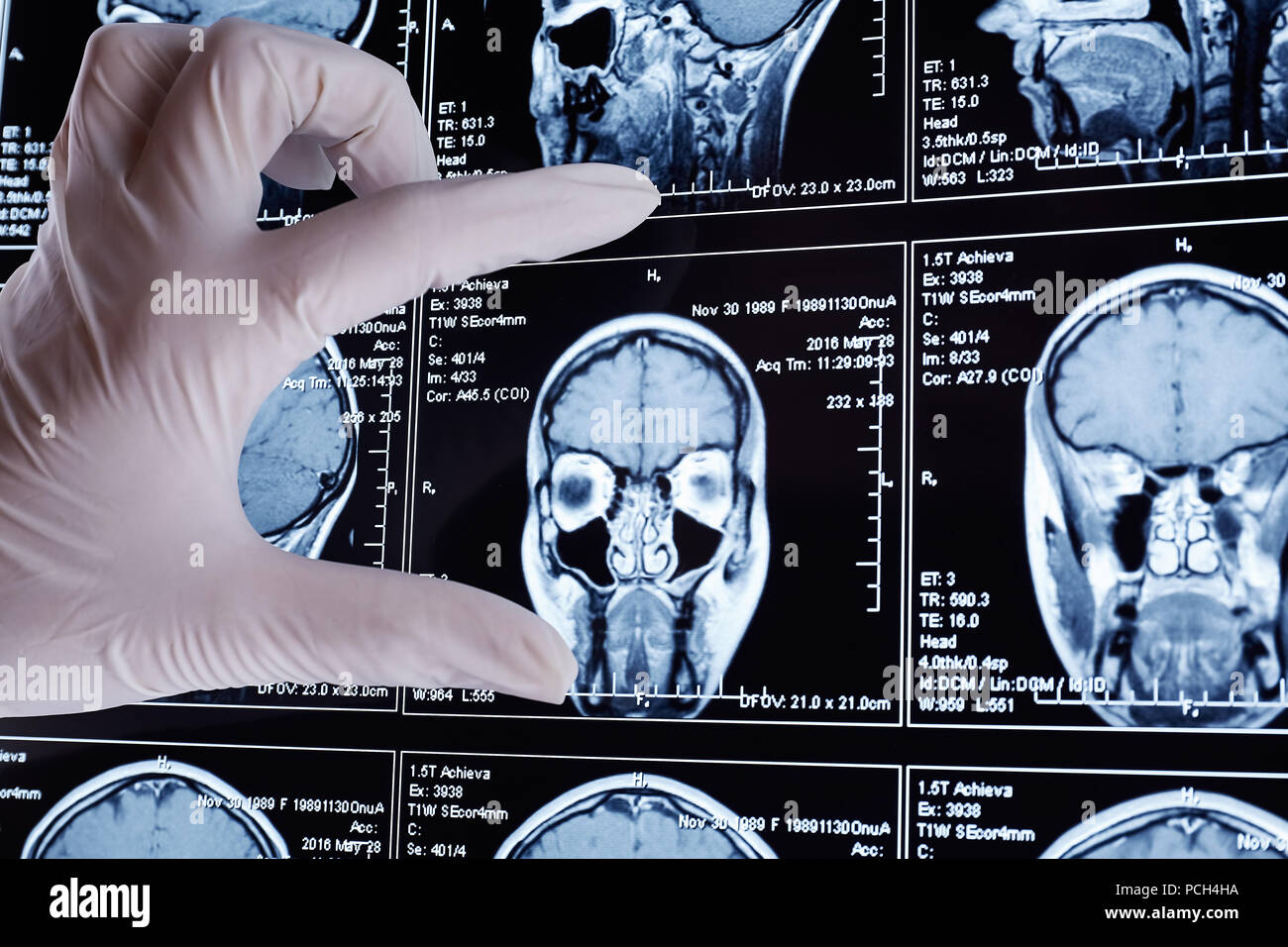 Magnetic resonance scan of the brain. MRI head scan Stock Photo - Alamy