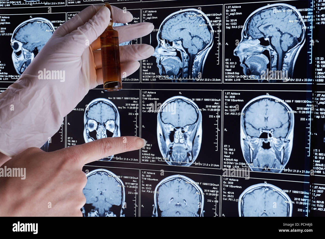 Magnetic resonance scan of the brain. MRI head scan Stock Photo - Alamy