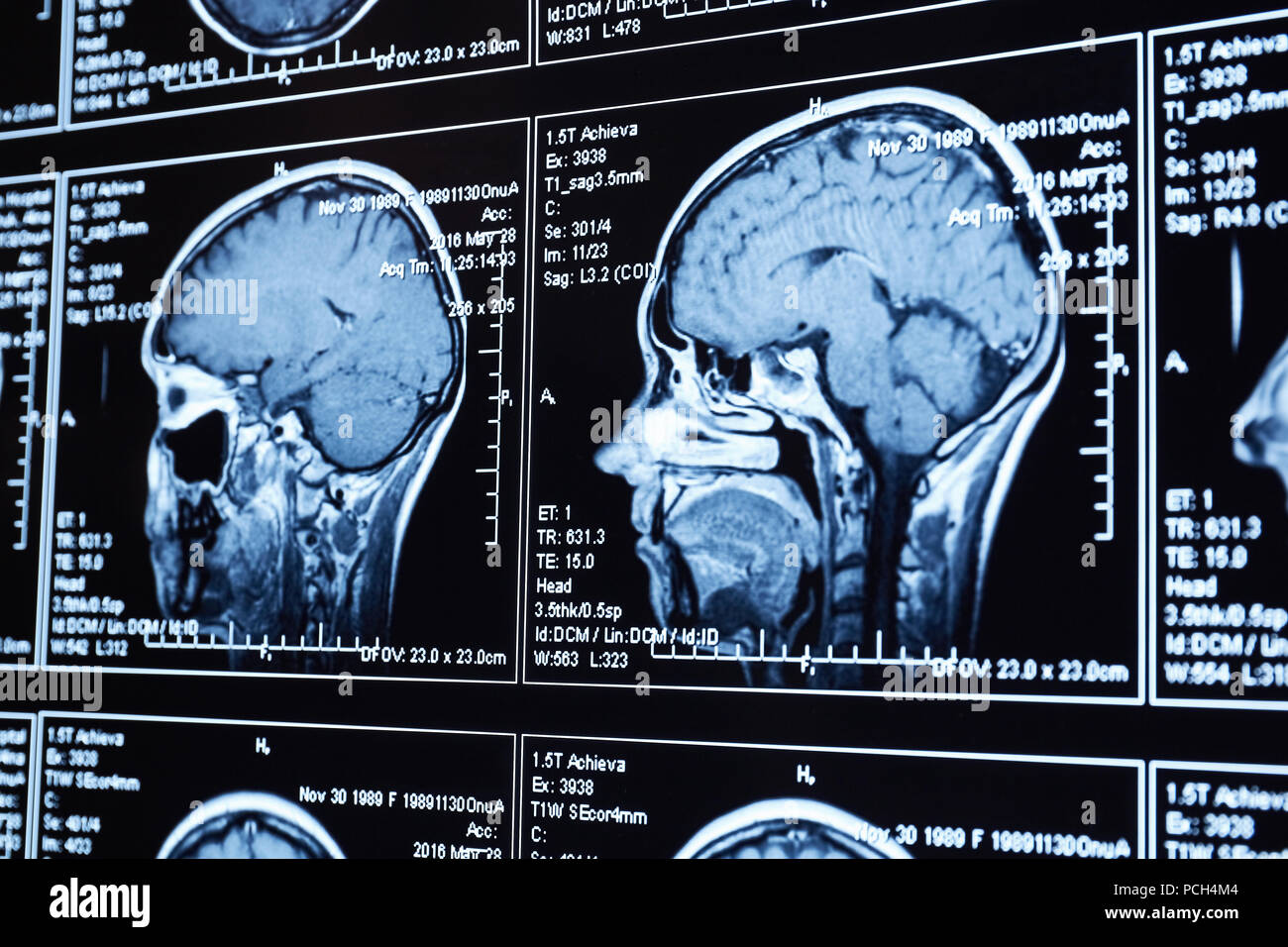 Magnetic resonance scan of the brain. MRI head scan Stock Photo - Alamy