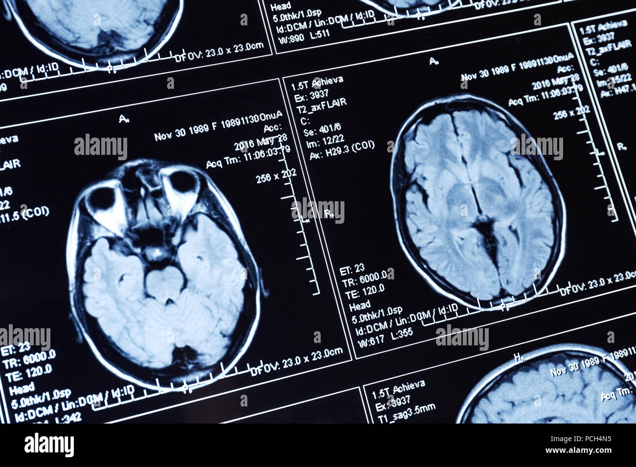 Magnetic resonance scan of the brain. MRI head scan Stock Photo - Alamy