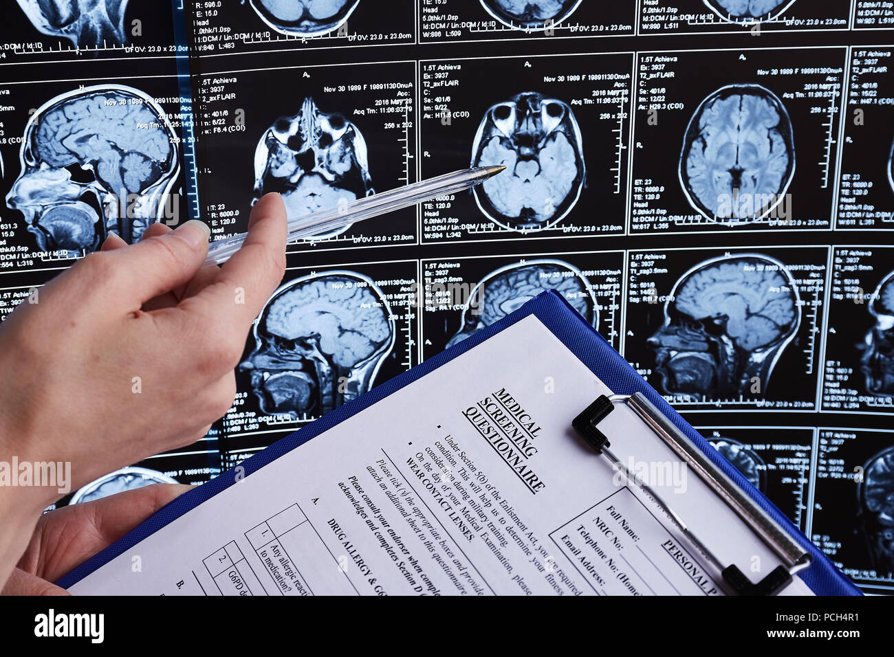 Mri scan brain injury hi-res stock photography and images - Alamy