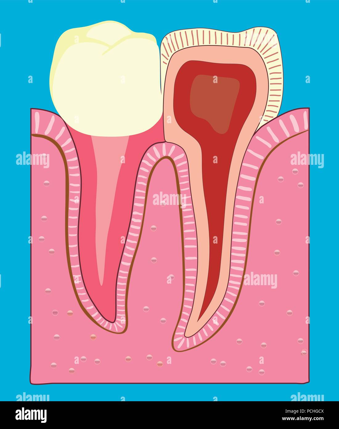 Dental caries cross section Stock Vector Images - Alamy