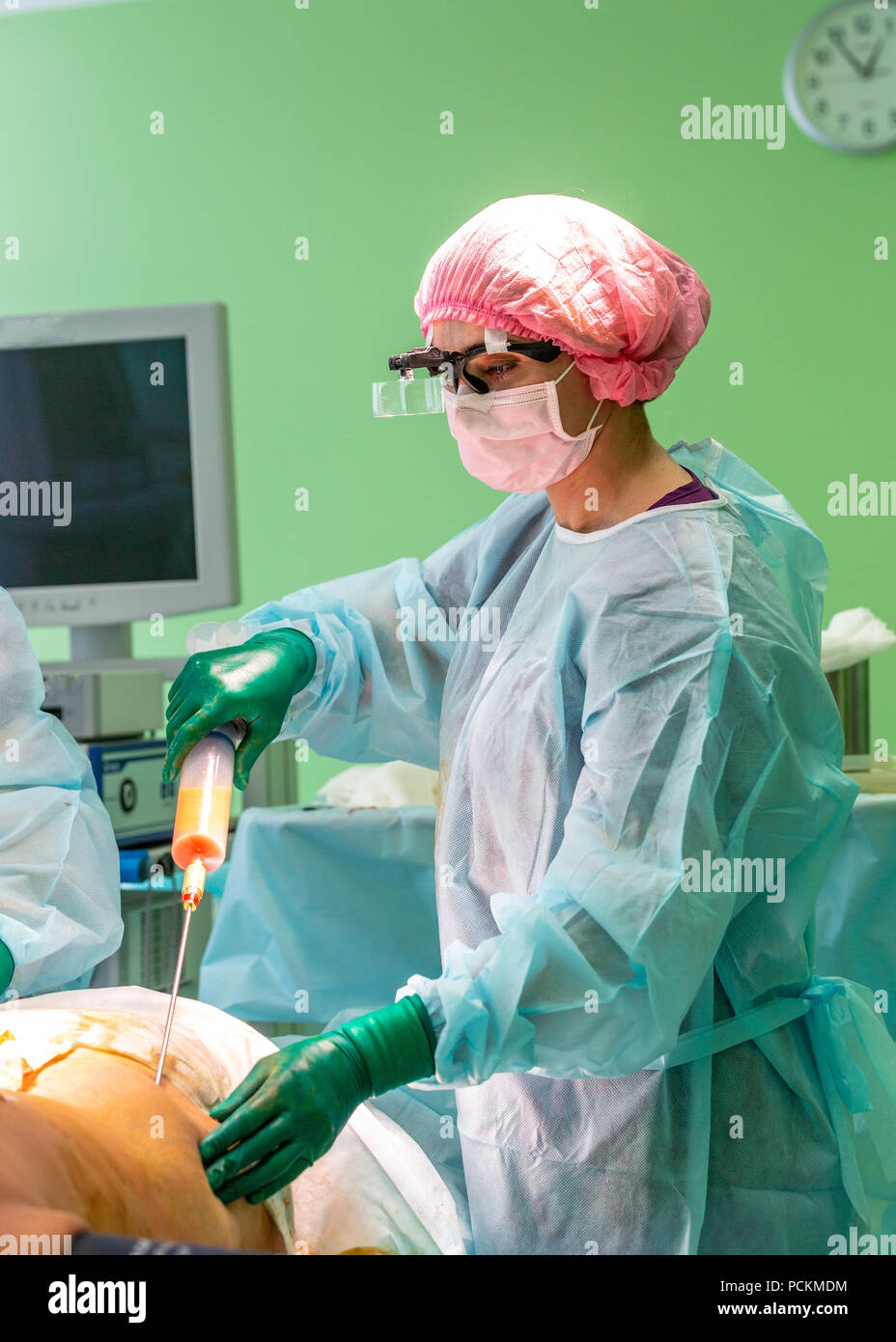 cosmetic liposuction surgery in actual operating room, group of ...