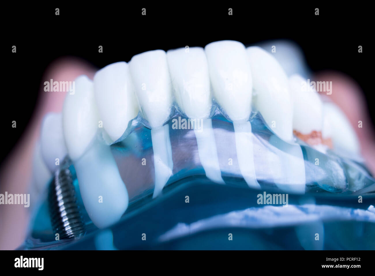 Dentist dental teeth teaching model showing titanium metal tooth ...