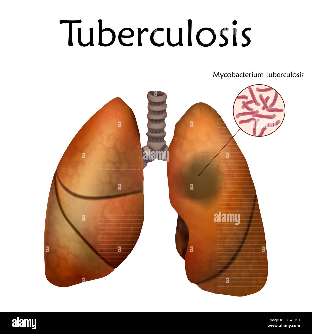 Tuberculosis, illustration. An infectious disease caused by the ...
