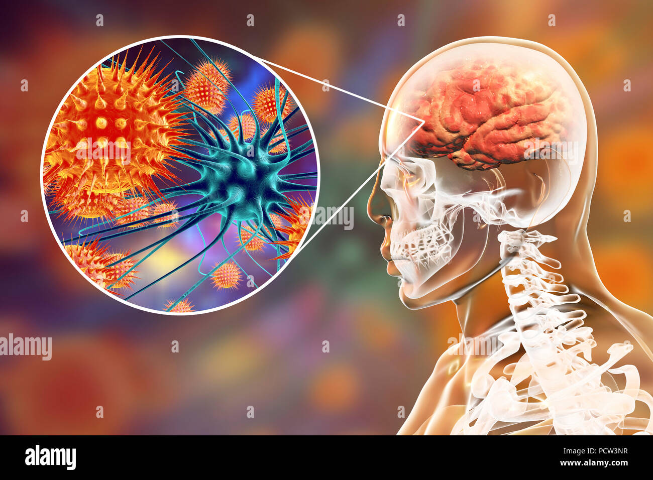 Viral encephalitis. Conceptual illustration showing brain with signs of ...