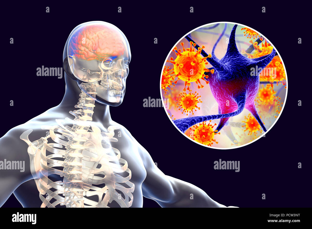 Viral encephalitis. Conceptual illustration showing brain with signs of ...
