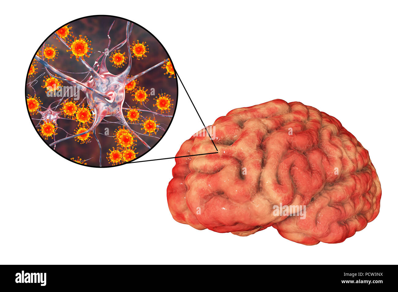 Viral encephalitis. Conceptual illustration showing brain with signs of ...