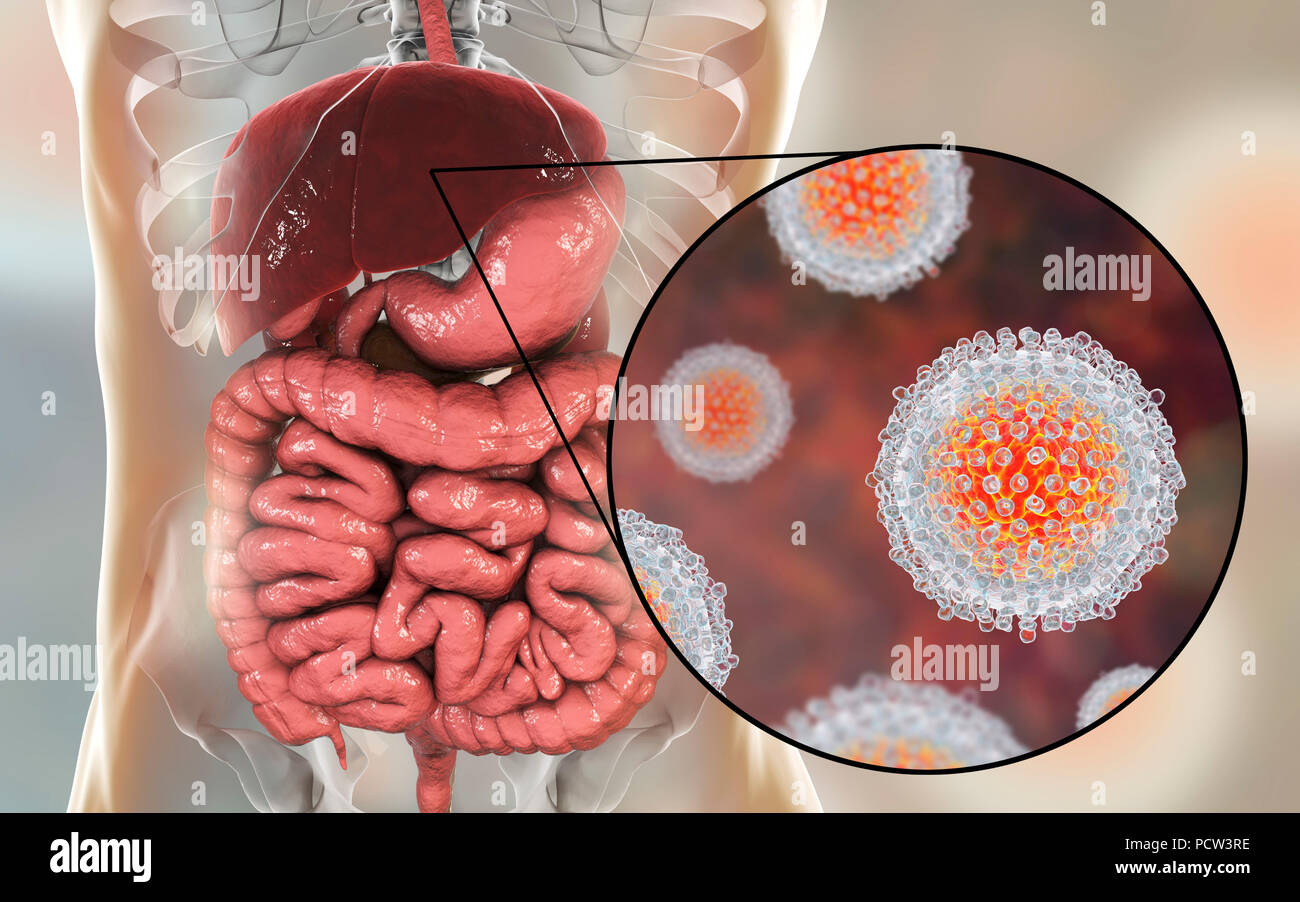 Hepatitis C infection. Computer illustration showing liver and close-up ...