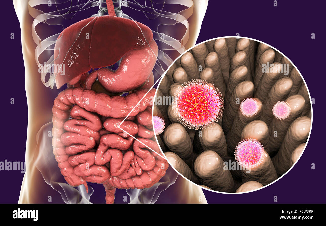 Rotaviruses infecting intestine, computer illustration. The virus ...
