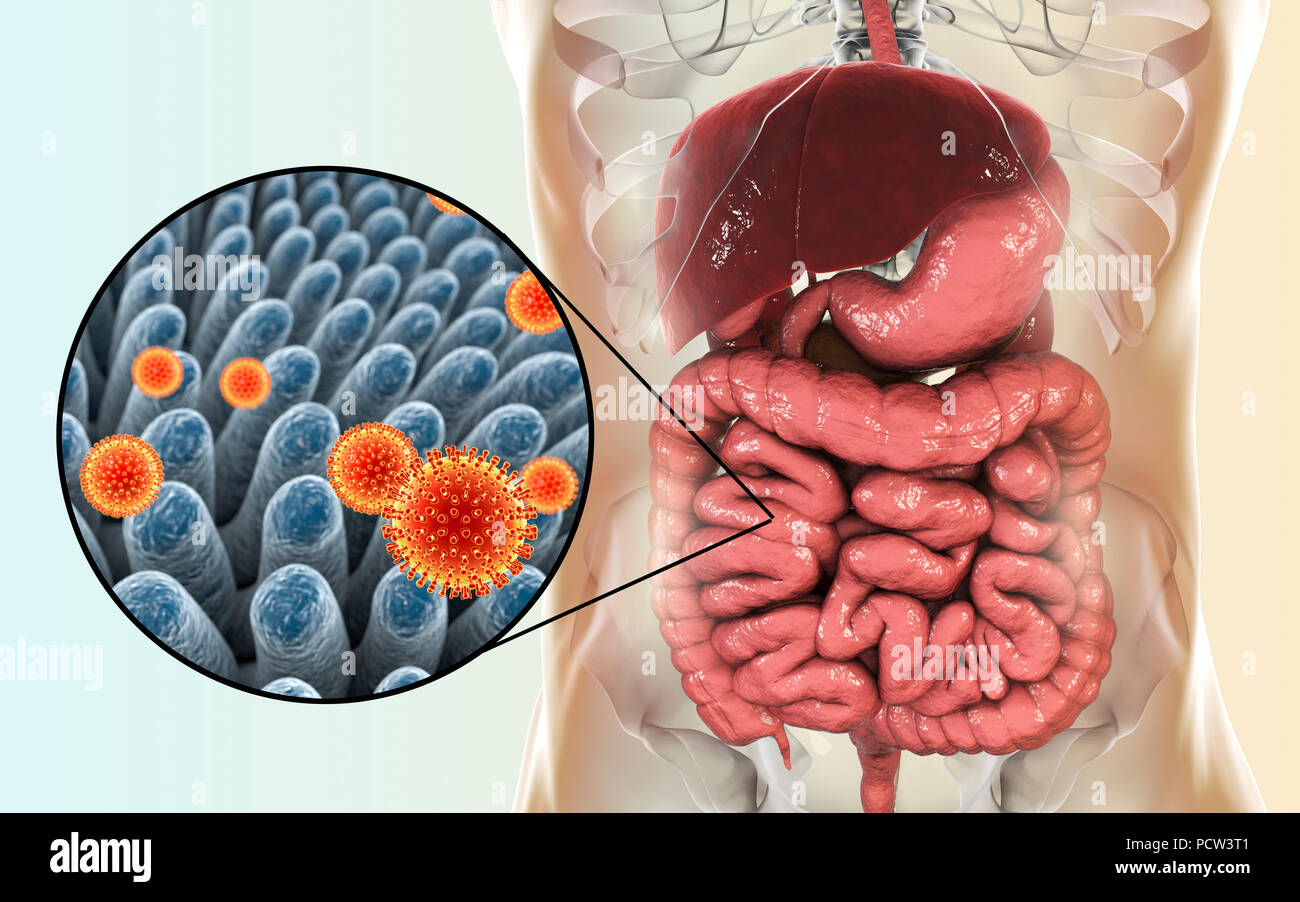 Rotaviruses infecting intestine, computer illustration. The virus ...