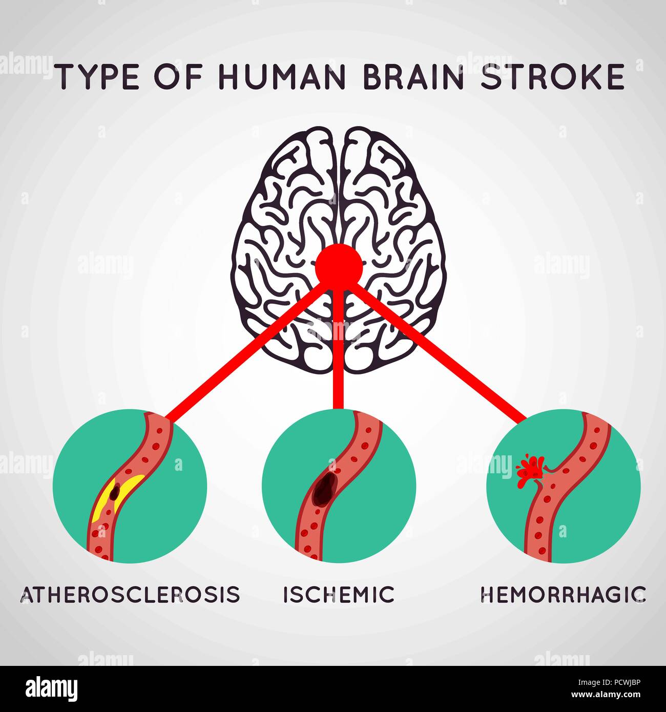 Brain Stroke vector logo icon illustration Stock Vector Image & Art - Alamy
