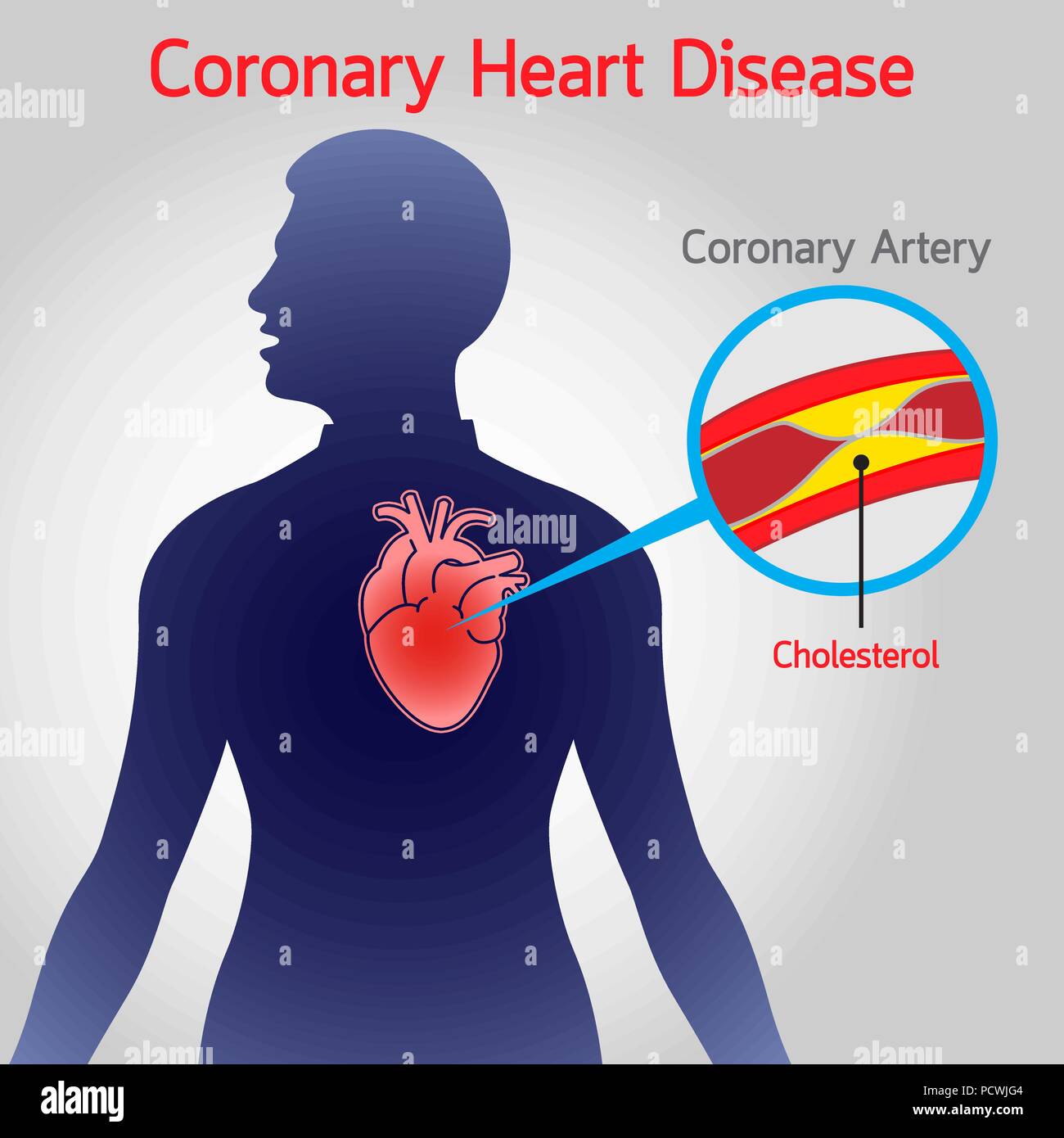 Coronary Heart Disease Diagram