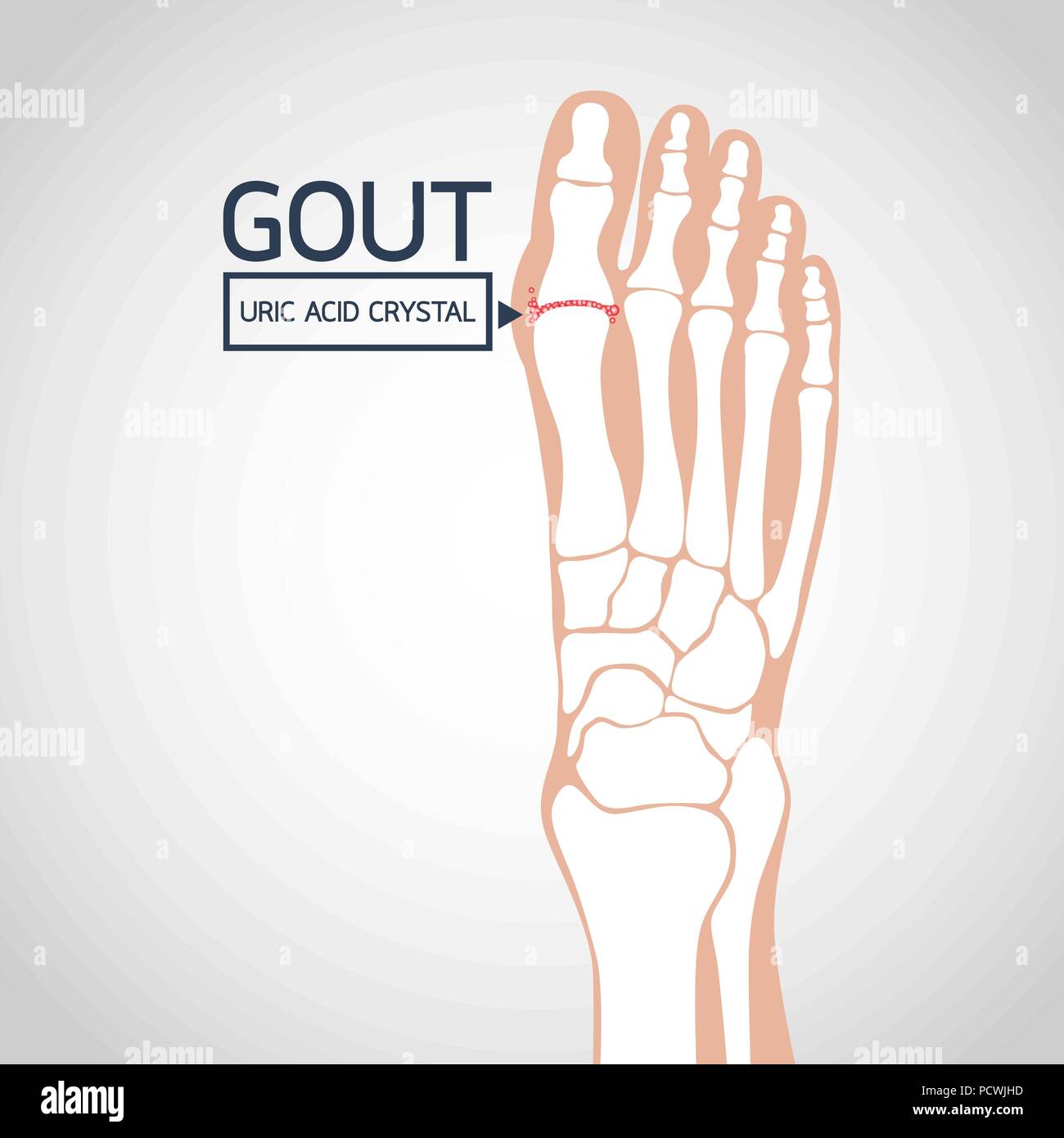 Foot gout Stock Vector Images - Alamy