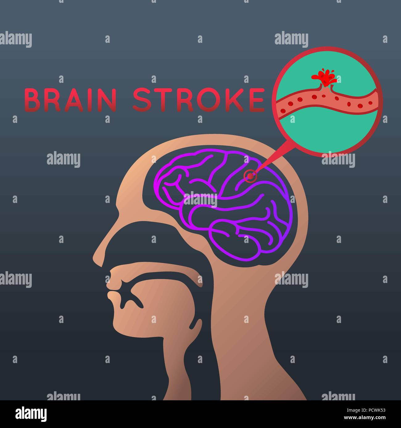 Ischemic Stroke High Resolution Stock Photography and Images - Alamy