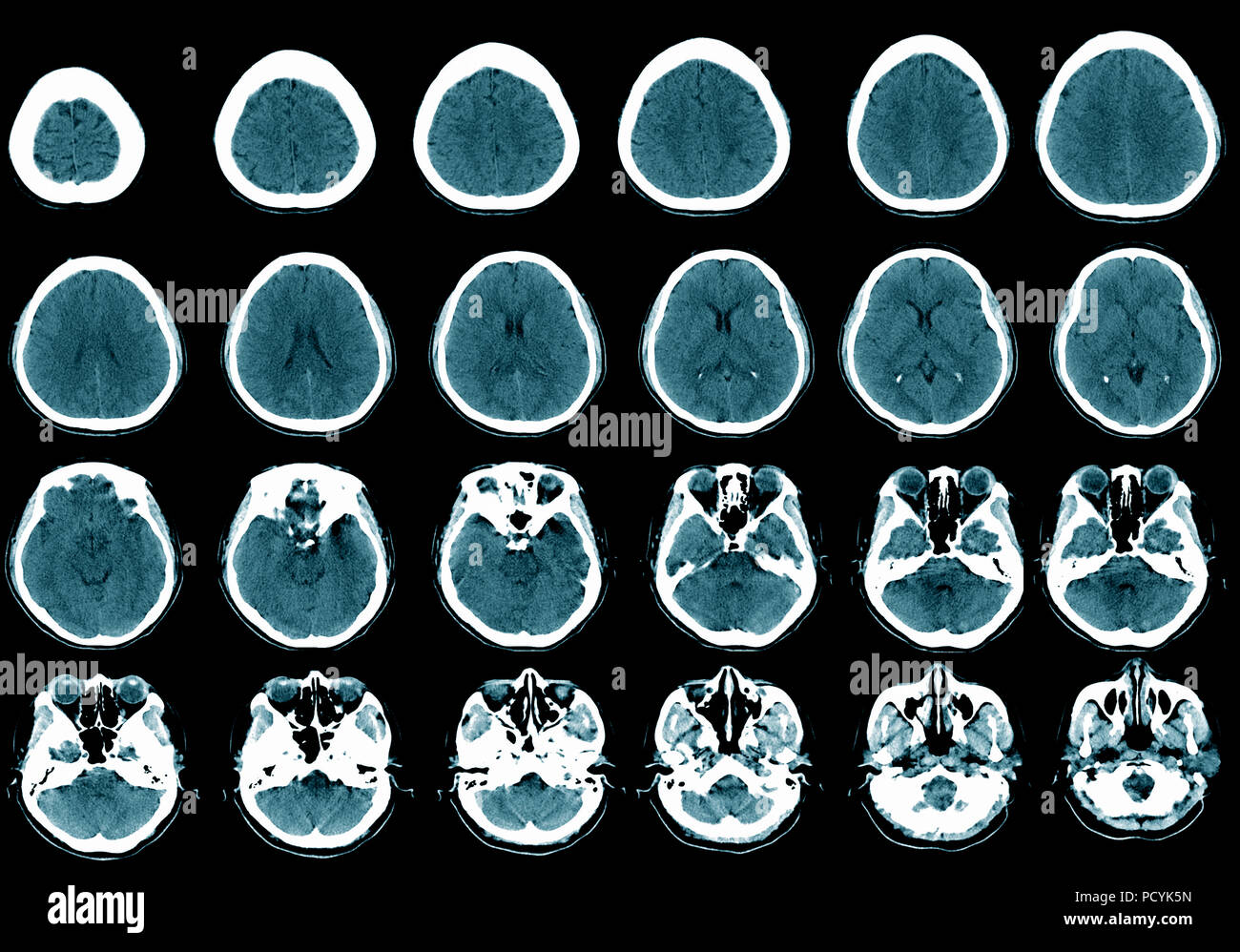 Brain tumor film ct scan brain hi-res stock photography and images - Alamy
