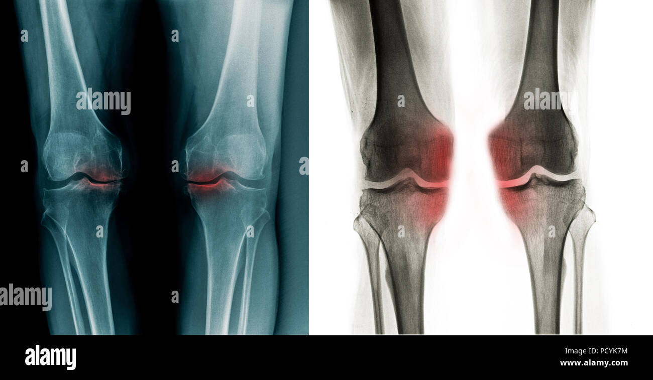 Knee osteoarthritis xray hi-res stock photography and images - Alamy