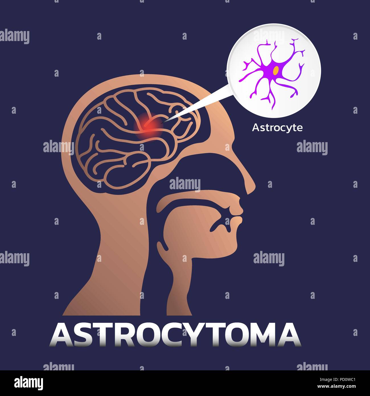 Glioma tumor Stock Vector Images - Alamy
