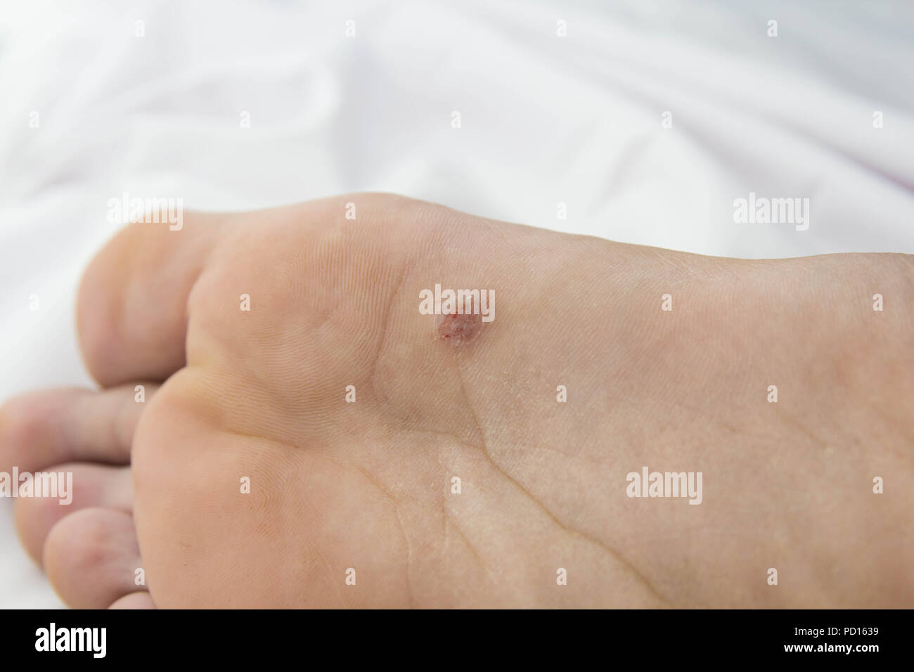 Verruca foot hi-res stock photography and images - Alamy