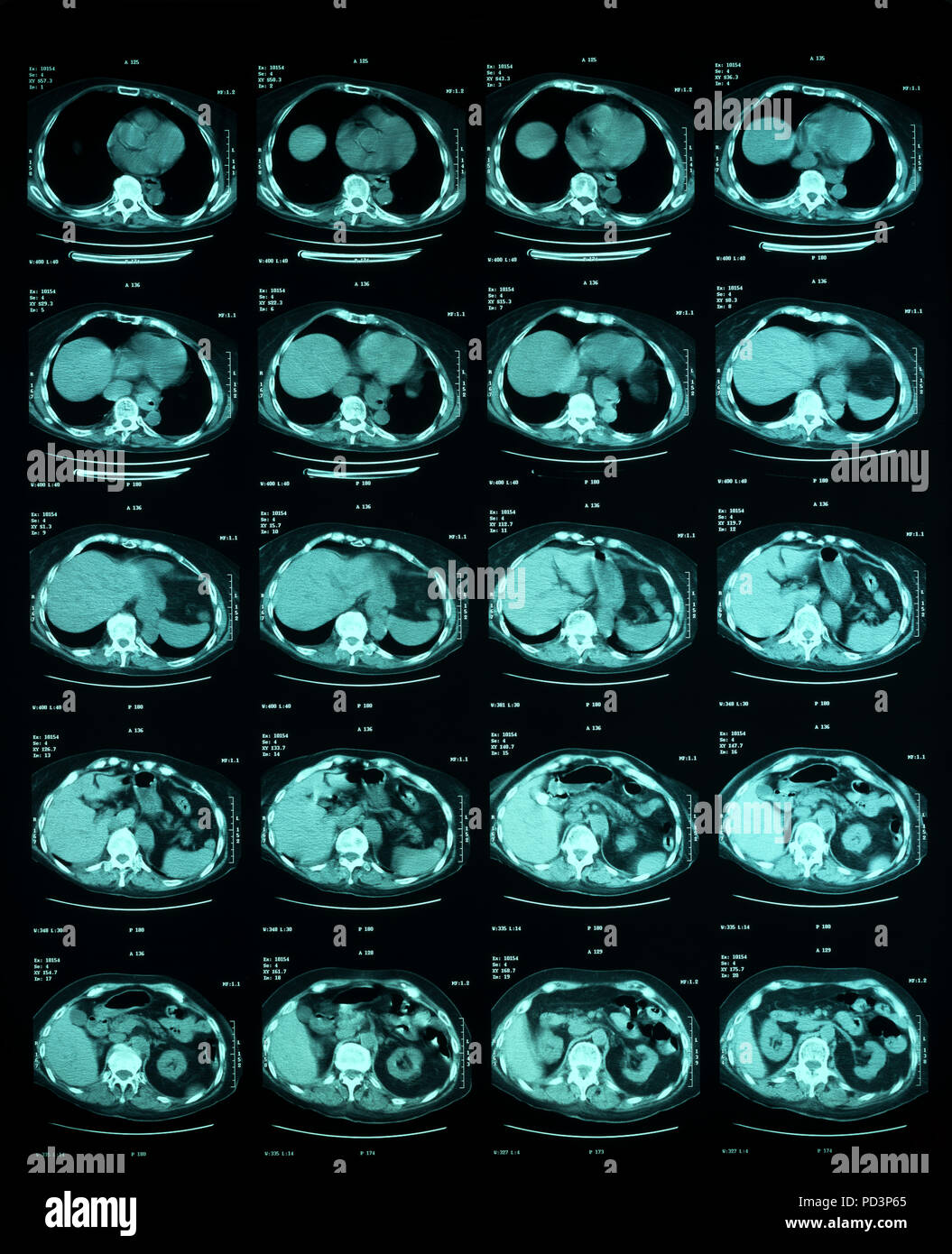 Sequence of horizontal sections of a female human brain, MRI scans ...