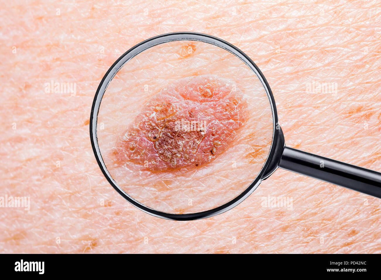 Skin Mole Defect High Magnification Macro Photo for Medical Diagnosis ...