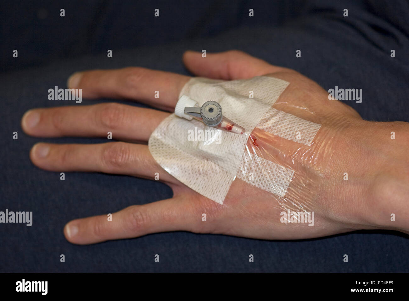 Cannula in back of hand hi-res stock photography and images - Alamy