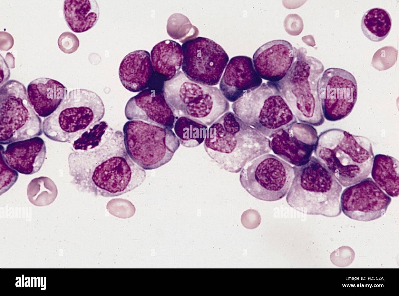 AML-M2 associated with a t(8;21) chromosome abnormality Stock Photo - Alamy