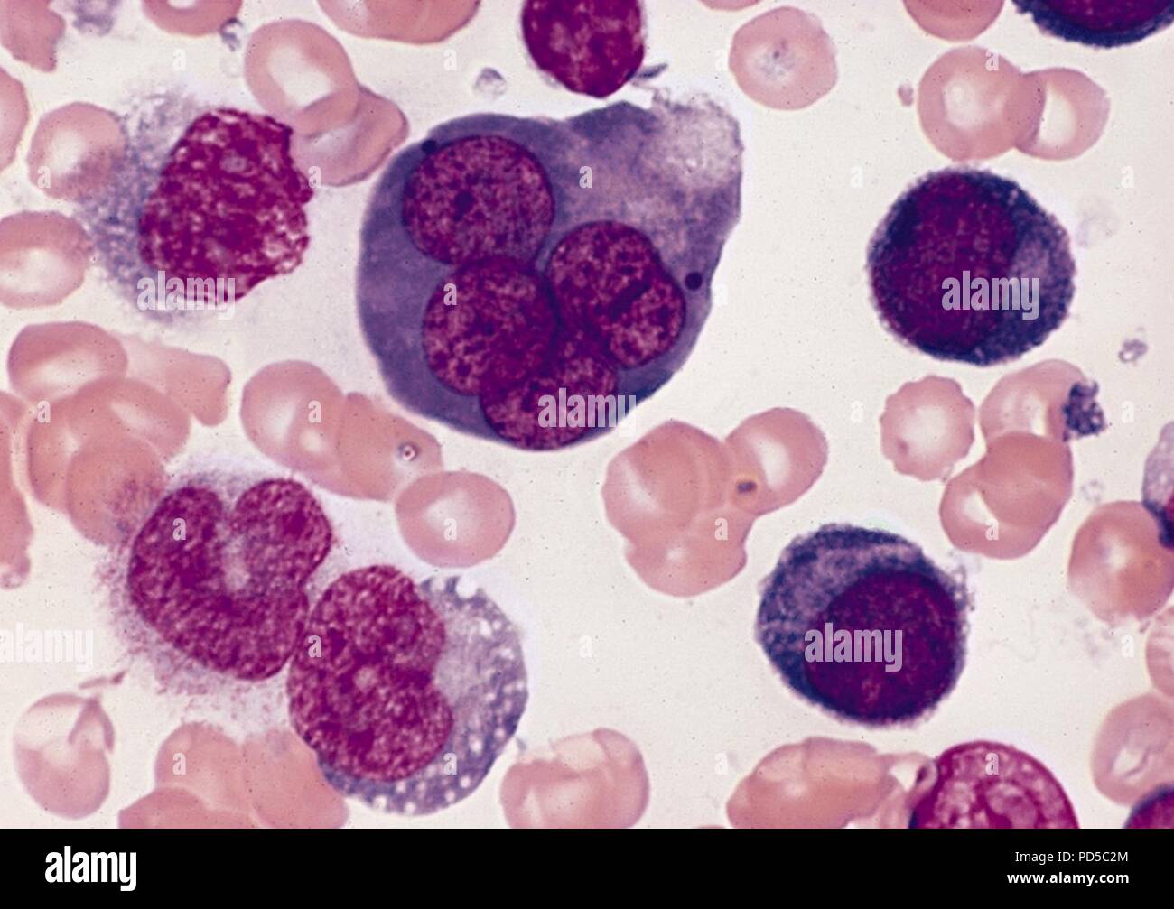 AML-M6 multinucleated erythroblast Stock Photo - Alamy